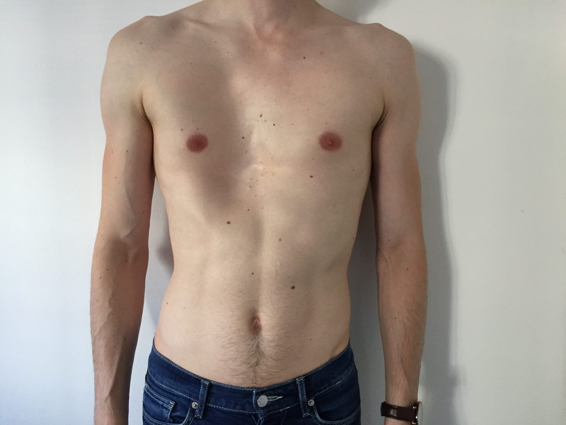 Attitude's Senior Writer on dealing with Pectus Excavatum - Attitude